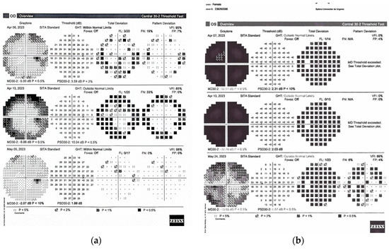 Visual Function Improvement after Plasma Exchange Therapy for Acute Optic Neuritis in ...
