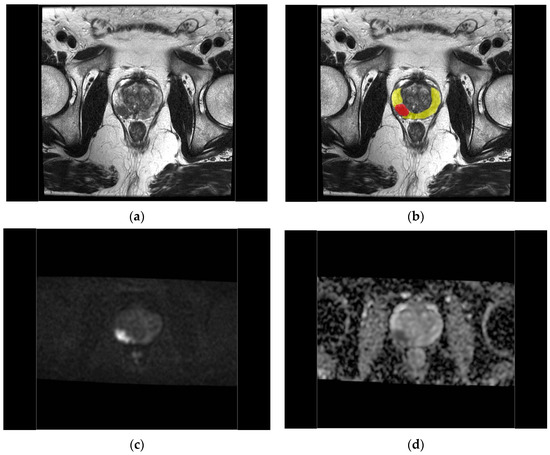 Diagnostics | Free Full-Text | Comparison of Early Contrast Enhancement ...
