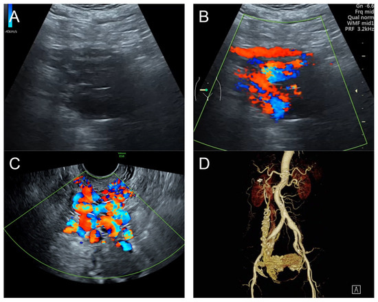 Sonographic Features of Uterine Arteriovenous Malformation: A Case Series