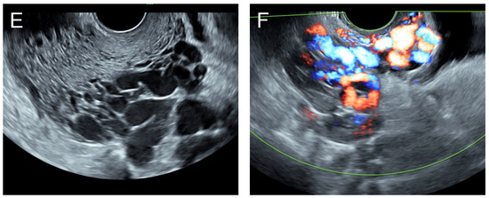Sonographic Features of Uterine Arteriovenous Malformation: A Case Series