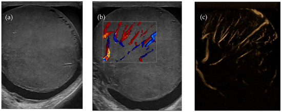 A Late Testicular Relapse in an Adult with Acute Lymphoblastic Leukemia ...