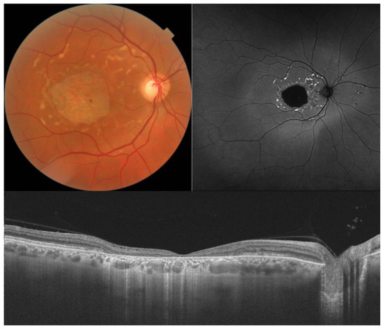 Optical Coherence Tomography in Inherited Macular Dystrophies: A Review
