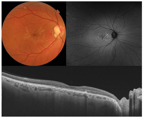 Optical Coherence Tomography in Inherited Macular Dystrophies: A Review