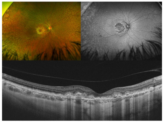 Optical Coherence Tomography in Inherited Macular Dystrophies: A Review