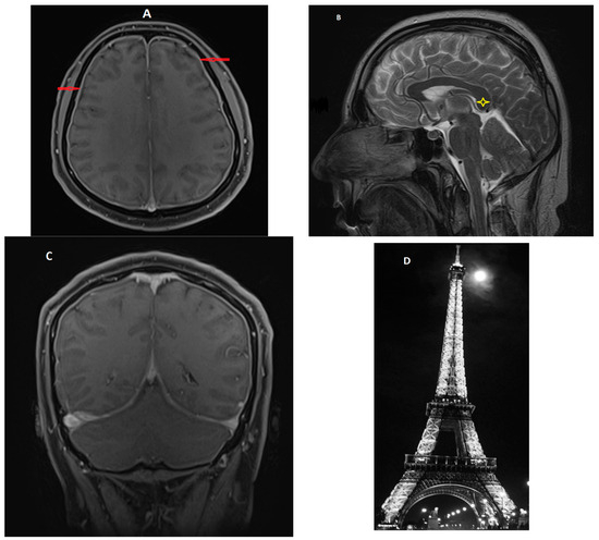 Spontaneous Intracranial Hypotension: Case Report and Update on ...
