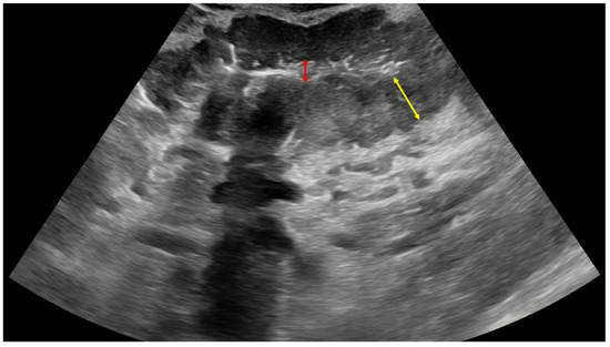 Pseudokidney Sign in Gastric Cancer