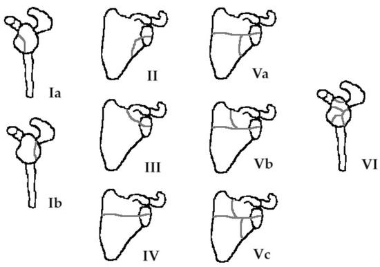 The Role of Arthroscopy in Contemporary Glenoid Fossa Fracture Fixation