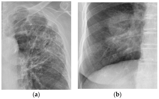 Deep Learning-Based Classification and Semantic Segmentation of Lung ...