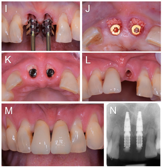 Immediate Implant Placement with Immediate Restorations after Dental ...