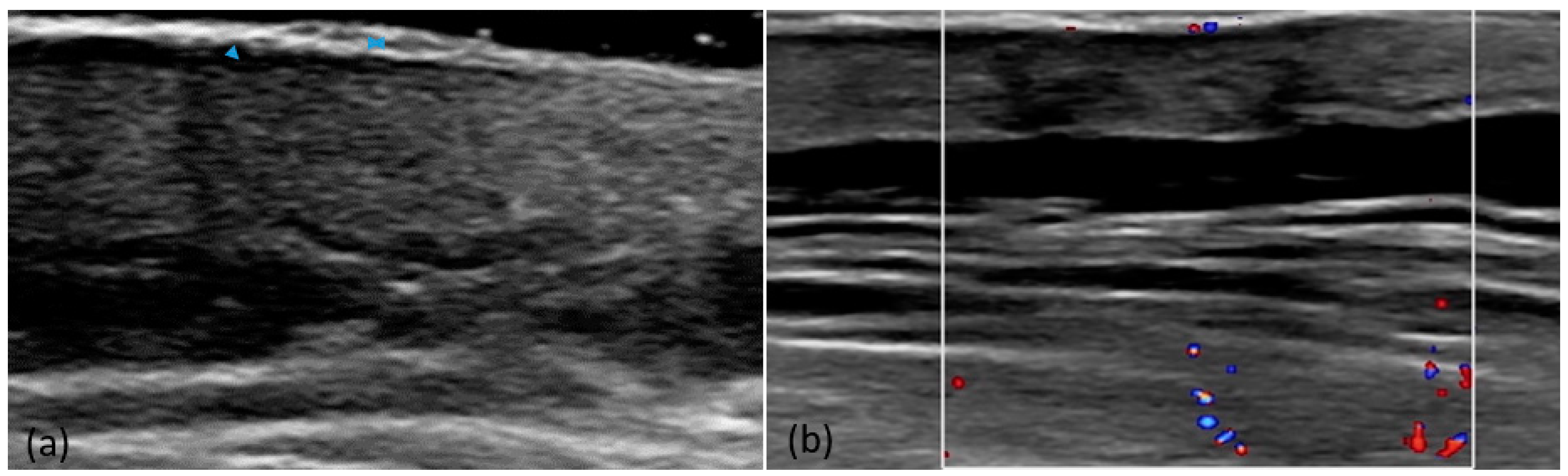 Imaging Approach in the Diagnostics and Evaluation of the Psoriasis ...