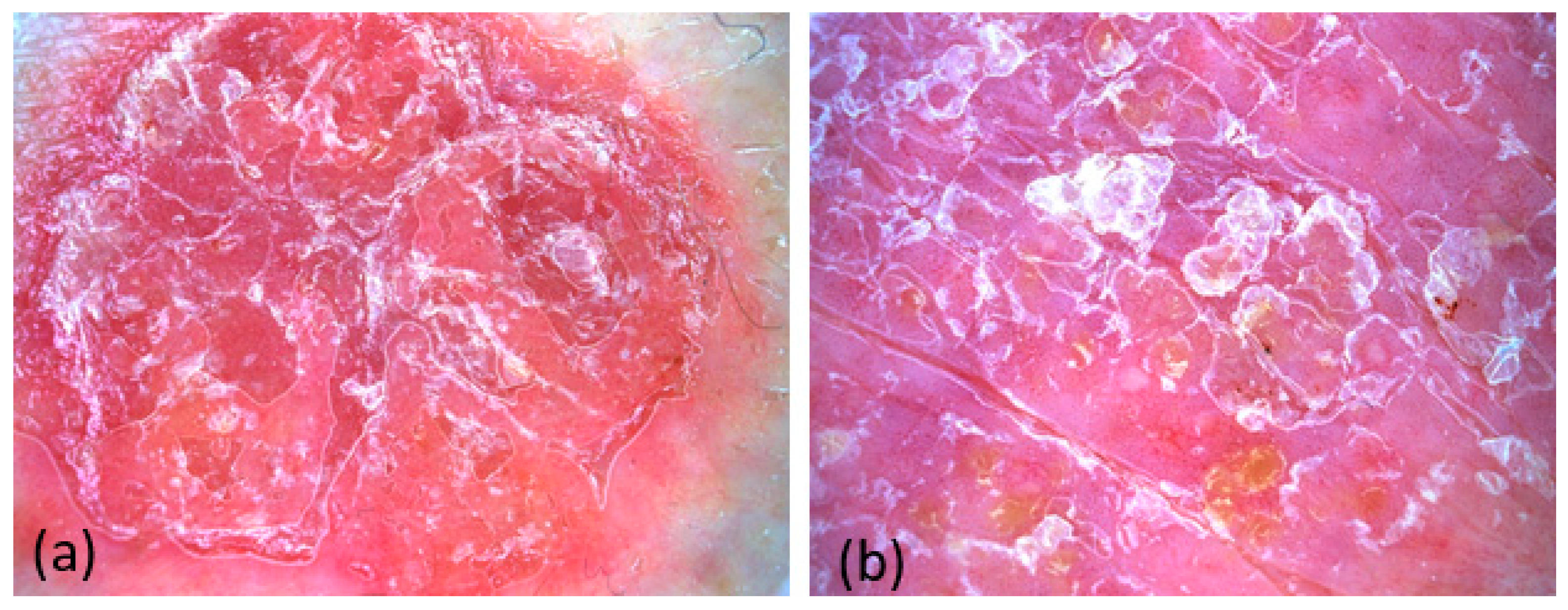 Imaging Approach in the Diagnostics and Evaluation of the Psoriasis ...