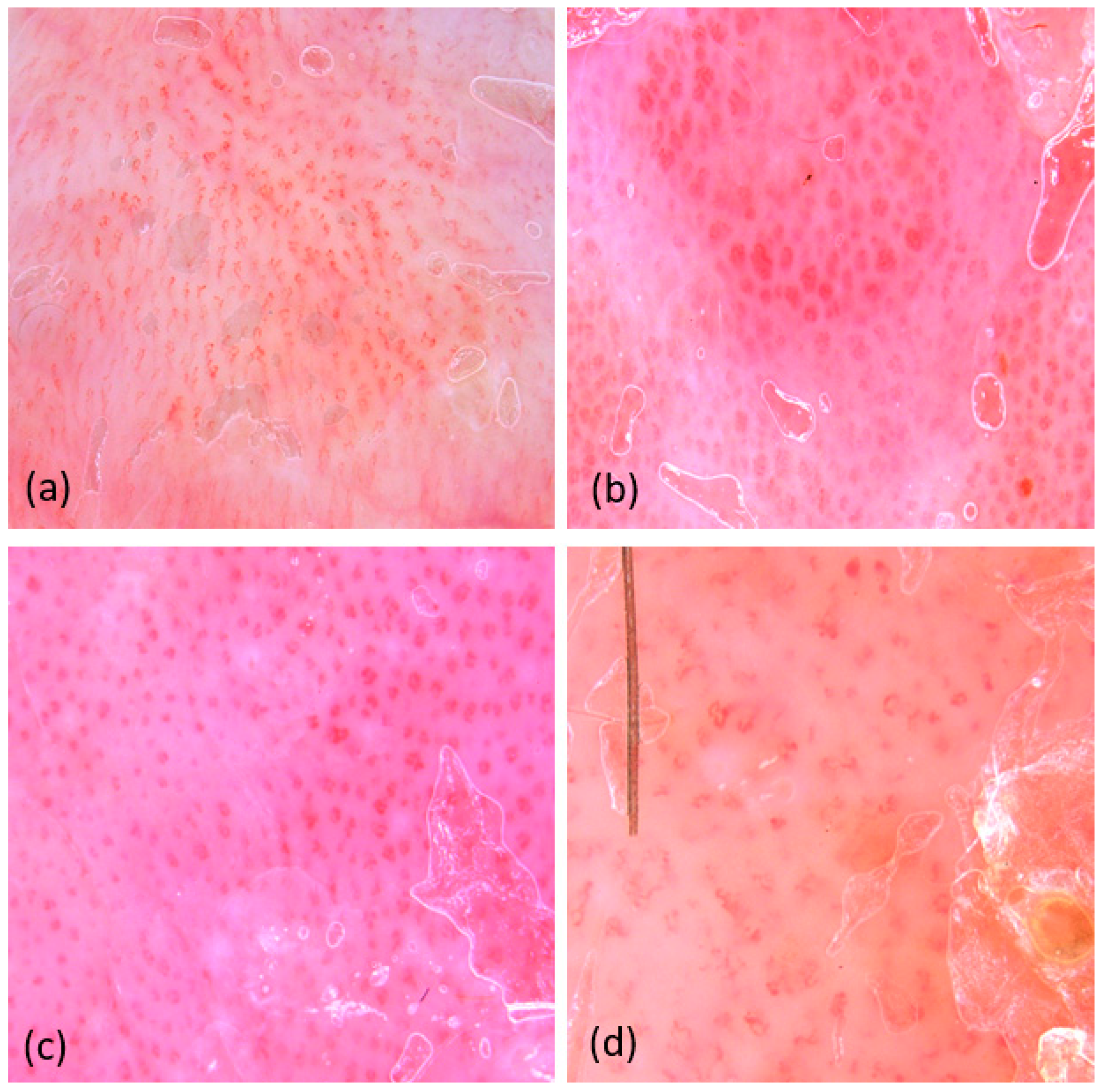 Imaging Approach in the Diagnostics and Evaluation of the Psoriasis ...