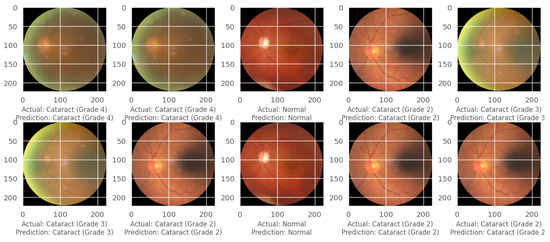 CSDNet: A Novel Deep Learning Framework for Improved Cataract State ...