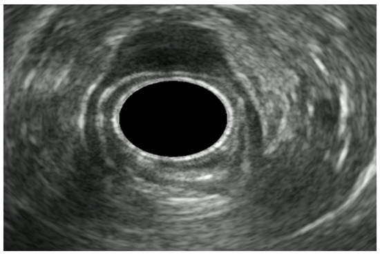 Diagnostic Endoscopic Ultrasound (EUS) of the Luminal Gastrointestinal ...