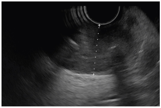 Diagnostic Endoscopic Ultrasound (EUS) of the Luminal Gastrointestinal ...