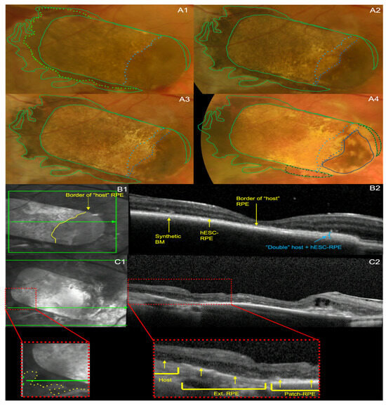 The Fate of RPE Cells Following hESC-RPE Patch Transplantation in ...