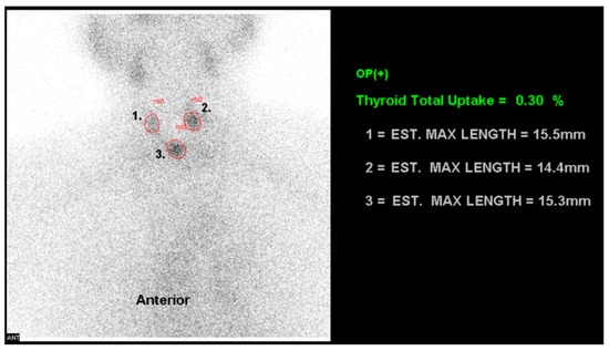 Diagnostics | Free Full-Text | Simplified Assessment of Radioiodine ...