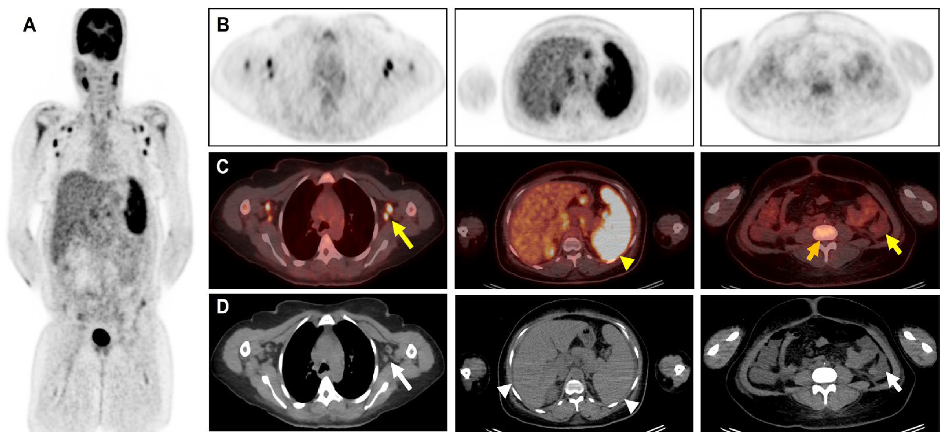 TAFRO Syndrome on 18F-FDG-PET/CT: An Appealing Diagnostic Tool