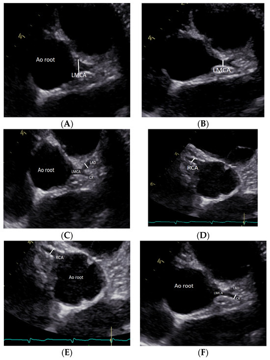 Comprehensive Two-Dimensional Pediatric Echocardiographic Nomograms for ...