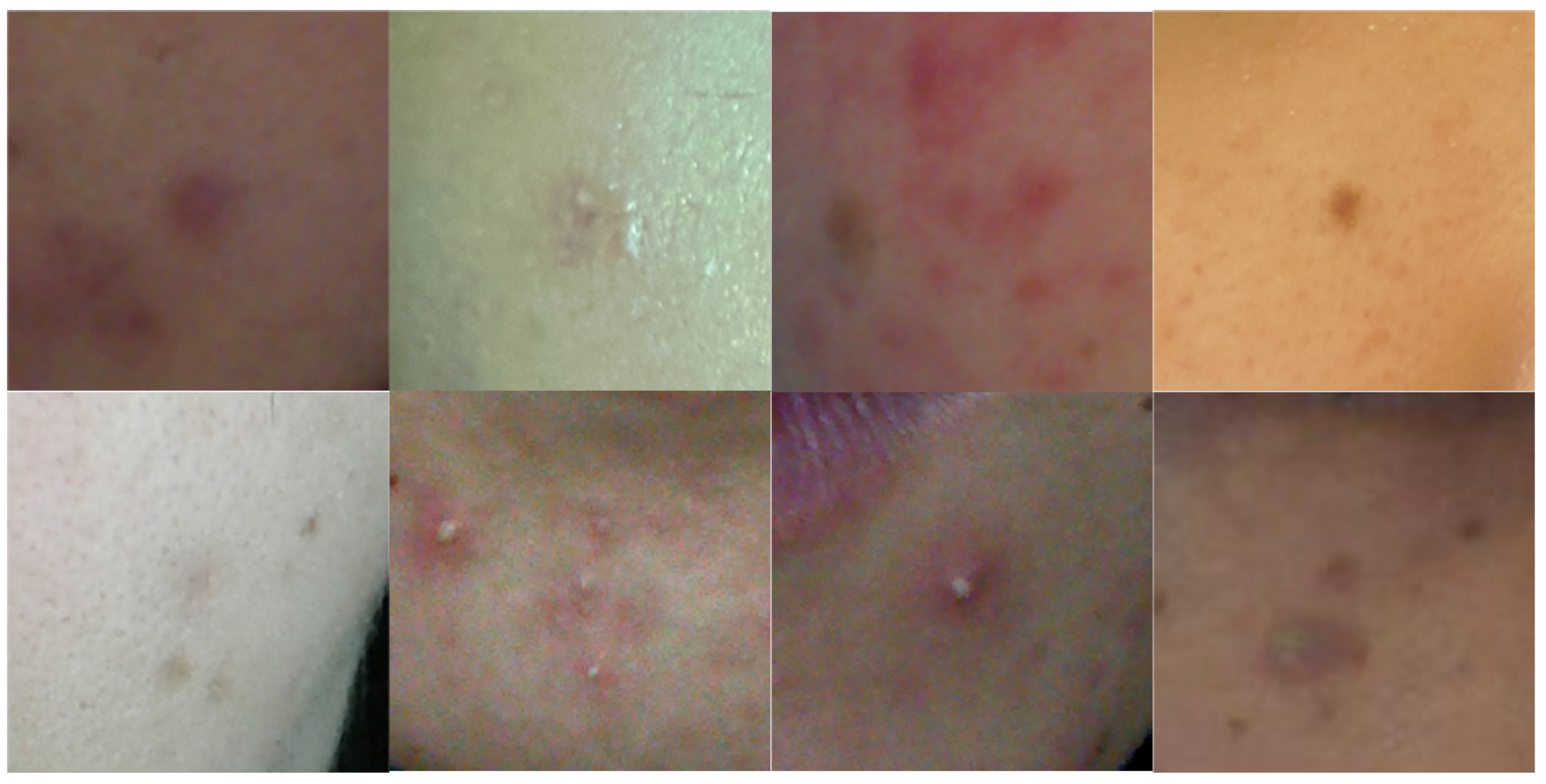 Diagnostics | Free Full-Text | Semi-Supervised Facial Acne Segmentation Using Bidirectional Copy ...