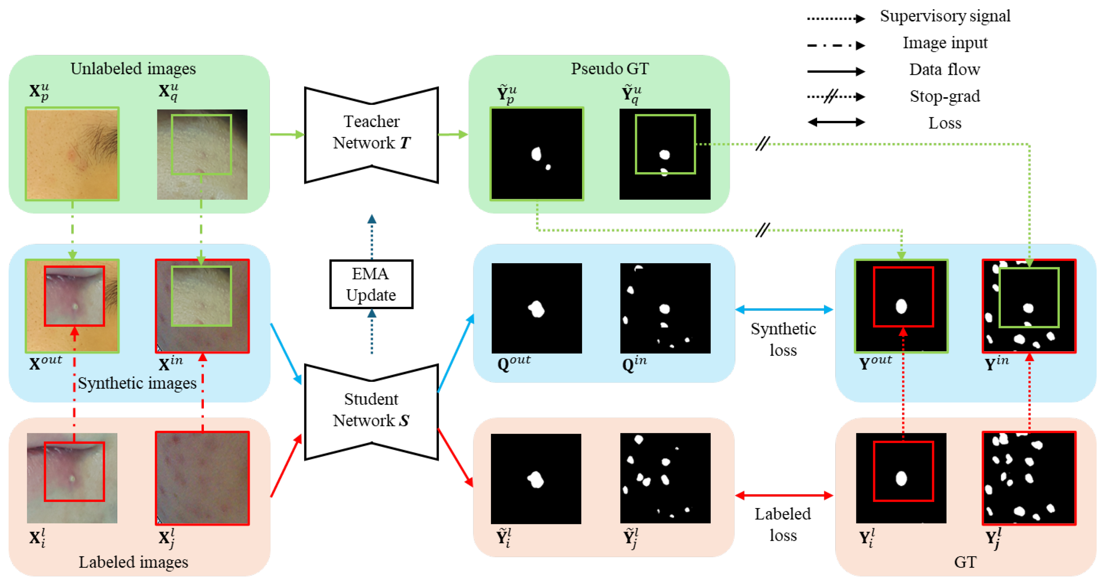 Semi-Supervised Facial Acne Segmentation Using Bidirectional Copy–Paste