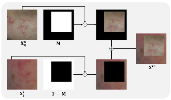 Semi-Supervised Facial Acne Segmentation Using Bidirectional Copy–Paste