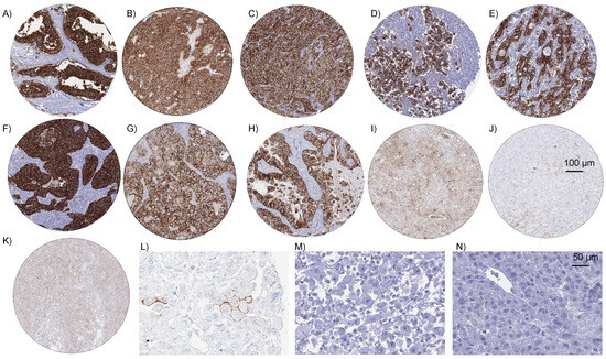 Epithelial Cell Adhesion Molecule (EpCAM) Expression in Human Tumors: A ...