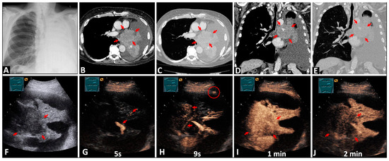 The Value of Contrast-Enhanced Ultrasound (CEUS) in the Evaluation of ...