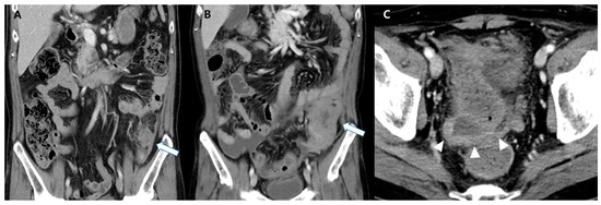 Myeloid Sarcoma of the Colon Initially Presenting as a Paracolic ...