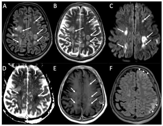 Neuroimaging of the Most Common Meningitis and Encephalitis of Adults ...