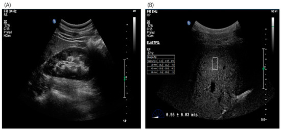 Assessing the Utility of Acoustic Radiation Force Impulse in the ...