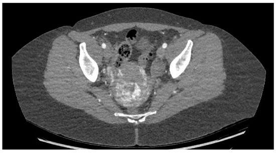 Uterine Arteriovenous Malformation: Diagnostic and Therapeutic Challenges