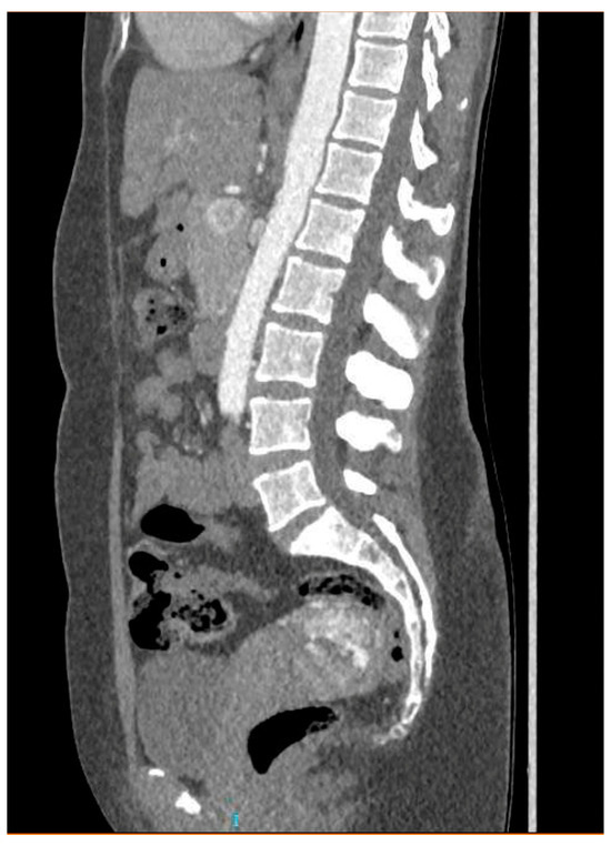 Uterine Arteriovenous Malformation: Diagnostic and Therapeutic Challenges