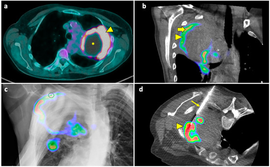 Computed-Tomography-Guided Lung Biopsy: A Practice-Oriented Document on ...