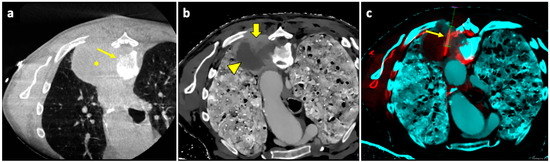 Computed-Tomography-Guided Lung Biopsy: A Practice-Oriented Document on ...