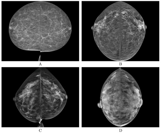 Enhancing Accuracy in Breast Density Assessment Using Deep Learning: A ...