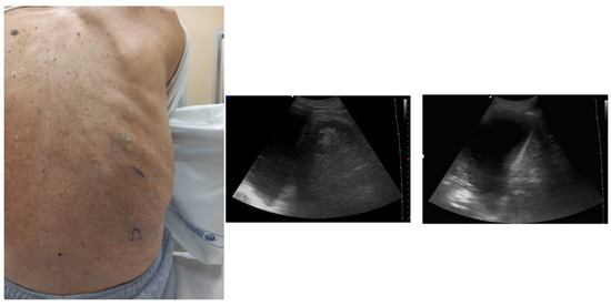 Ultrasound-Assisted and Ultrasound-Guided Thoracentesis: An Educational ...