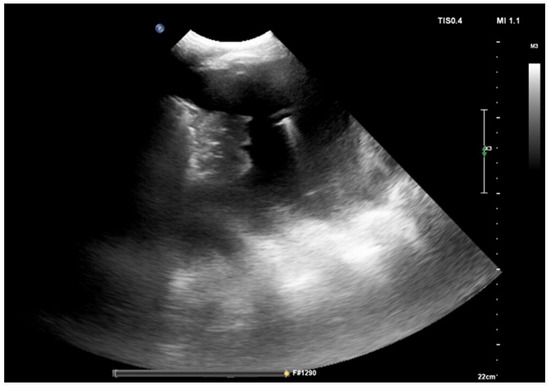 Ultrasound-Assisted and Ultrasound-Guided Thoracentesis: An Educational ...