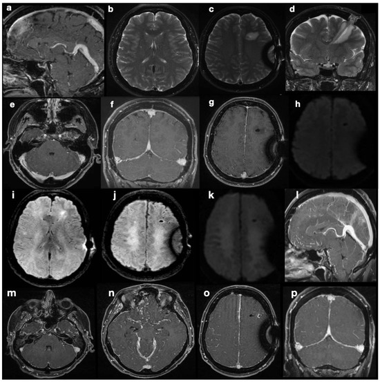 Rare Complications of CSF Diversion: Paradoxical Neuroimaging Findings in a Double, Chiasmic ...