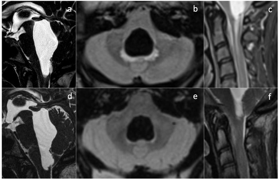 Rare Complications of CSF Diversion: Paradoxical Neuroimaging Findings ...