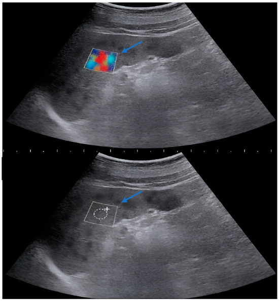 Shear Wave Ultrasonographic Elastography in Pediatric Spleens and Its ...