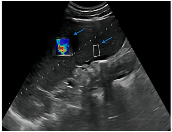 Shear Wave Ultrasonographic Elastography in Pediatric Spleens and Its ...