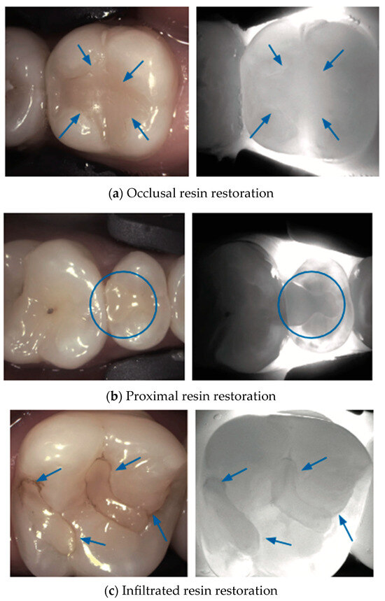 Atlas of Dental Near-Infrared Transillumination Images