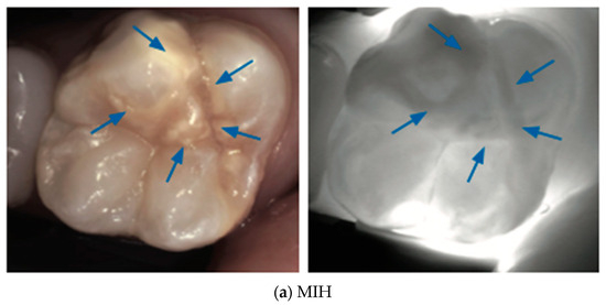 Atlas of Dental Near-Infrared Transillumination Images