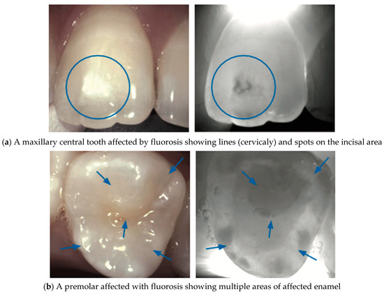 Atlas of Dental Near-Infrared Transillumination Images