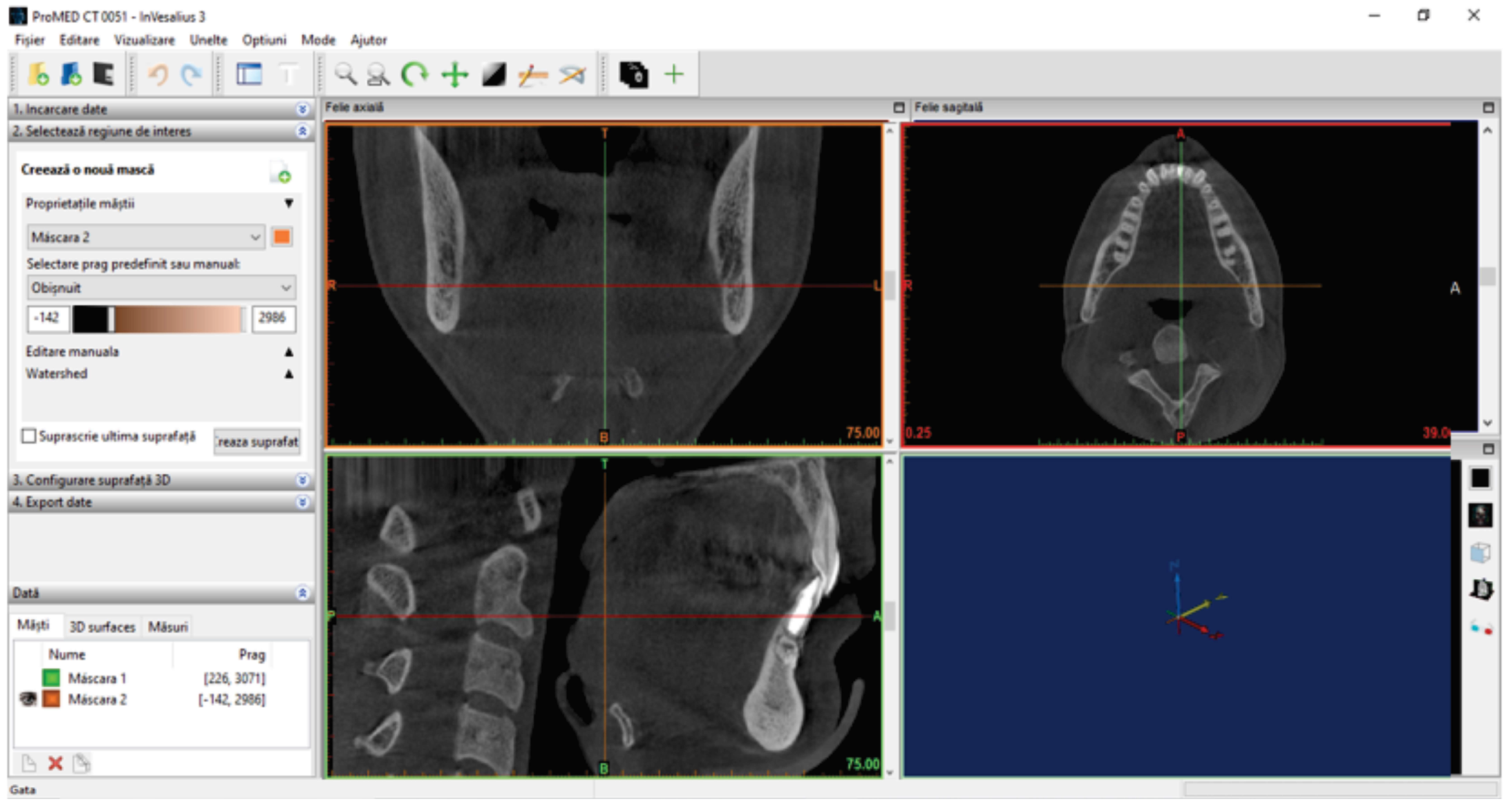 Orthodontic System Modeled and Simulated with the Lingual Technique to Assess Tooth Forces