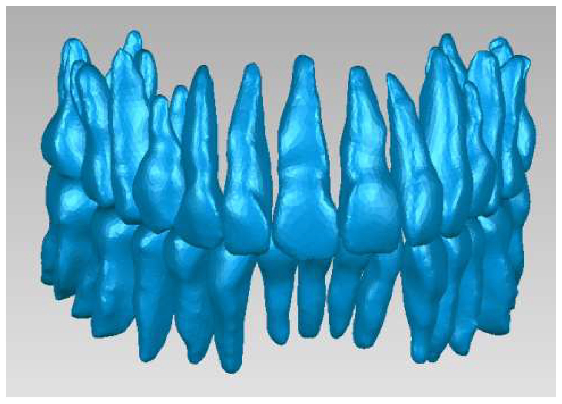 Orthodontic System Modeled and Simulated with the Lingual Technique to Assess Tooth Forces