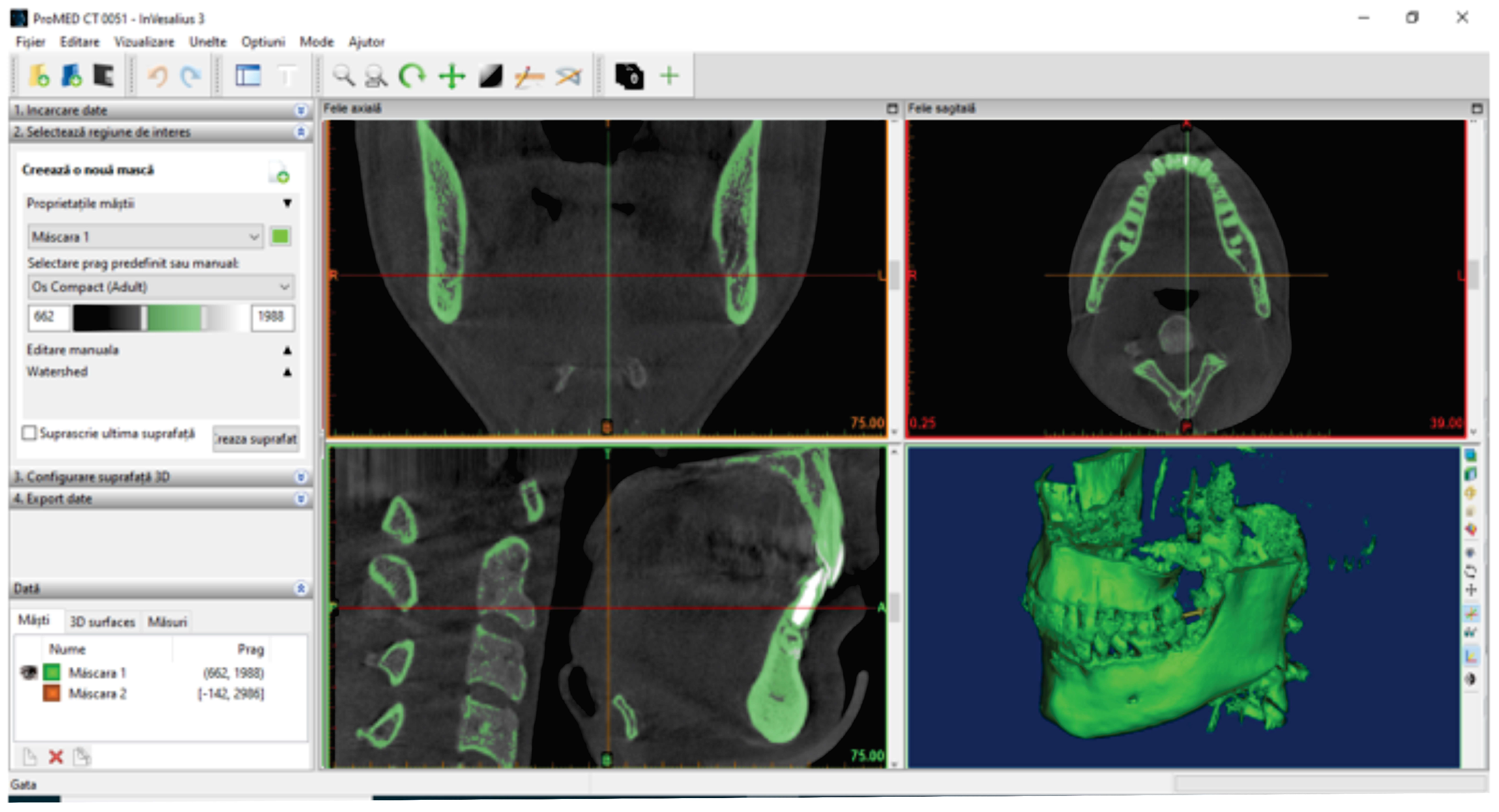 Orthodontic System Modeled and Simulated with the Lingual Technique to Assess Tooth Forces