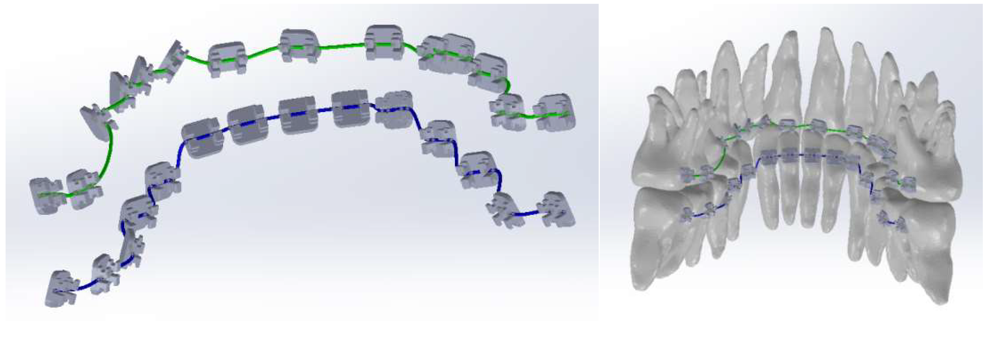 Orthodontic System Modeled and Simulated with the Lingual Technique to Assess Tooth Forces