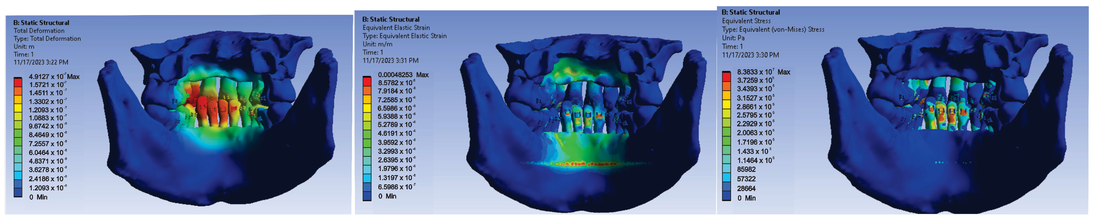Orthodontic System Modeled and Simulated with the Lingual Technique to Assess Tooth Forces